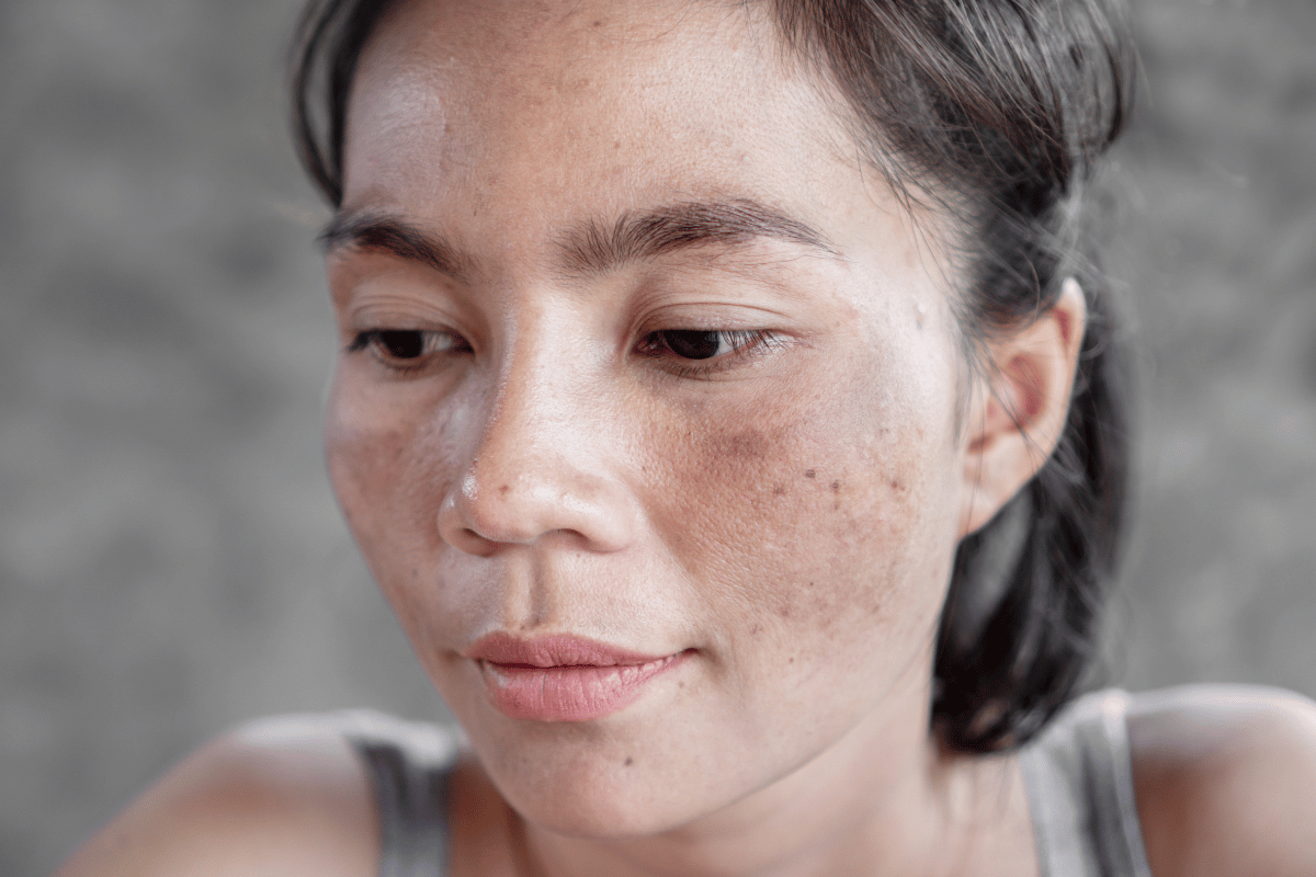 Reverse Sun Damage Naturally With This 1 Ayurvedic Remedy To Get